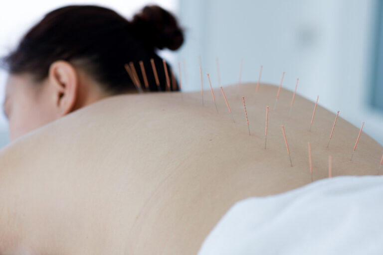Unlocking the Benefits of Dry Needling for Various Musculoskeletal ...